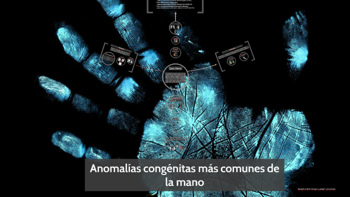 Anomalías congénitas más comunes de la mano by Gabriela Jara on Prezi