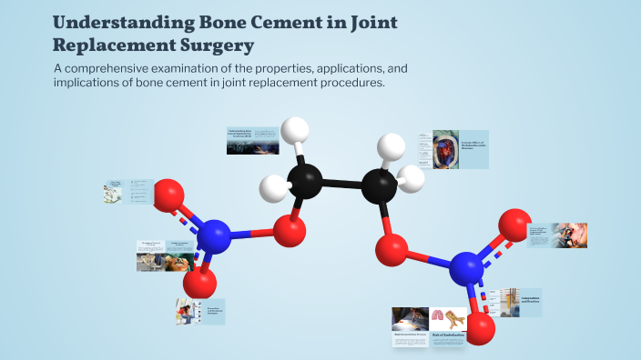 Understanding Bone Cement in Joint Replacement Surgery by Muhammad ...