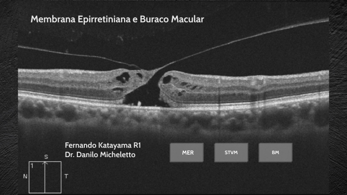 MER e Buraco Macular by fernando katayama on Prezi