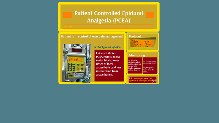 Patient Controlled Epidural Analgesia (PCEA) by Anne Devine