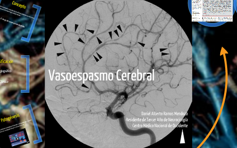 Vasoespasmo Cerebral by Daniel Alberto Ramos Mendoza on Prezi