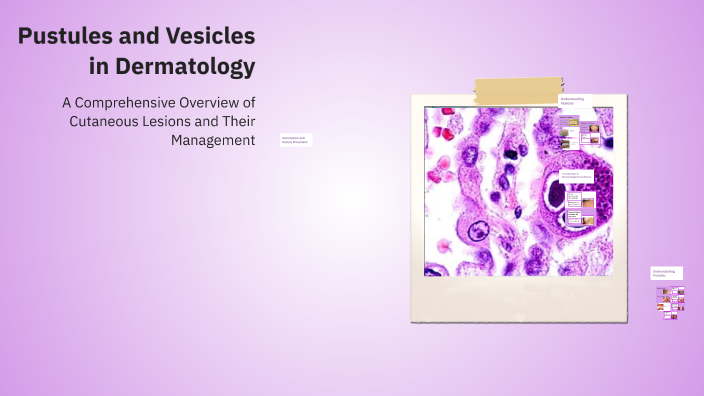 Pustules and Vesicles in Dermatology by Elena Pintus on Prezi