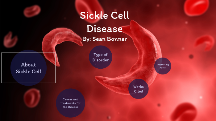 Sickle Cell Project by Sean Bonner on Prezi