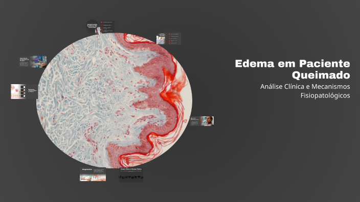Edema em Paciente Queimado by Ana Laura Bicalho Muzzi on Prezi