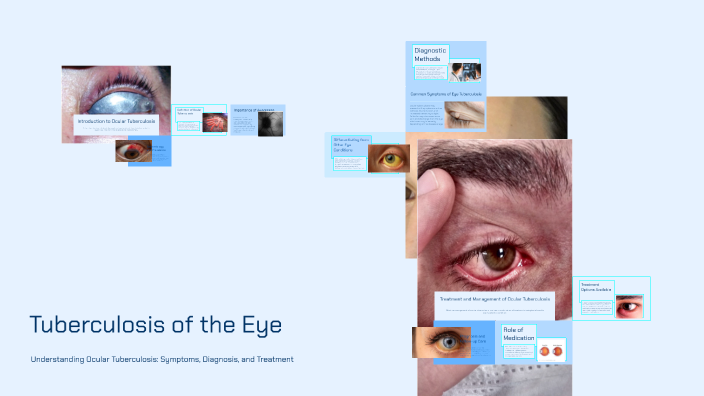 Tuberculosis of the Eye by Aitkul4 on Prezi