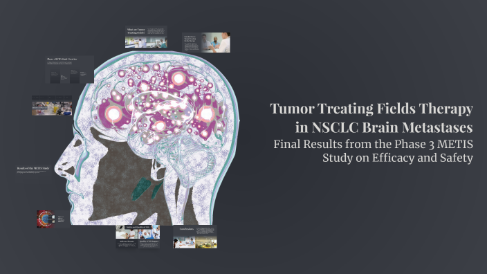Tumor Treating Fields Therapy in NSCLC Brain Metastases by Maria ...