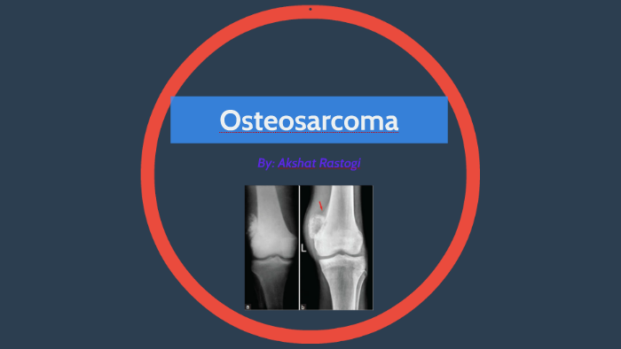 Osteosarcoma by Akshat Rastogi on Prezi
