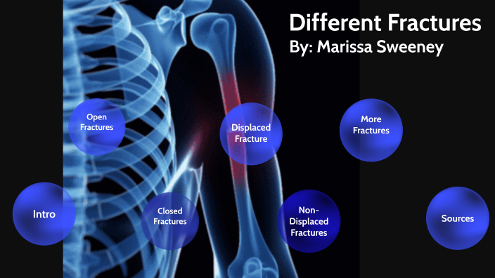 Fractures Report by Marissa Sweeney on Prezi
