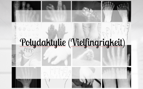 Polydaktylie by lynn may on Prezi