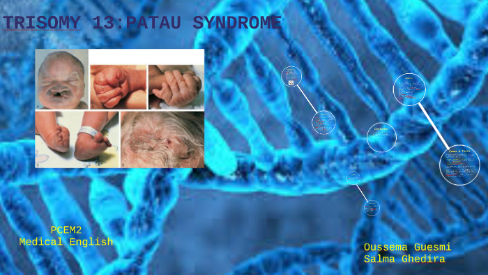 Trisomy 13 : PATAU syndrom by Kenza Ghedira on Prezi