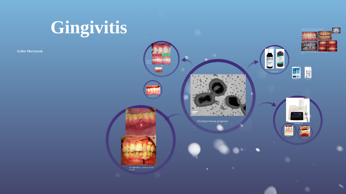 Gingivitis Project by Esther Martynyuk on Prezi