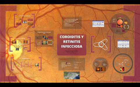 Coroiditis y retinitis infecciosa (MG) by Mel Stéfani on Prezi