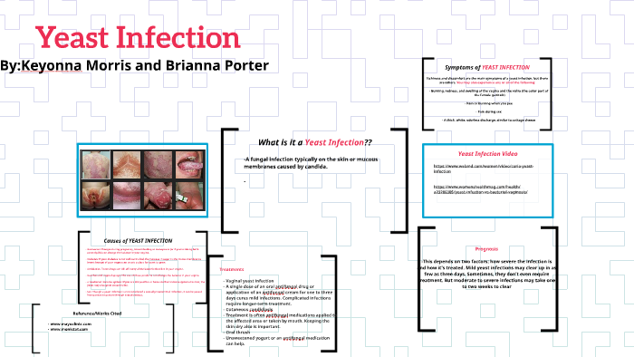 Yeast Infection by Keyonna Morris on Prezi