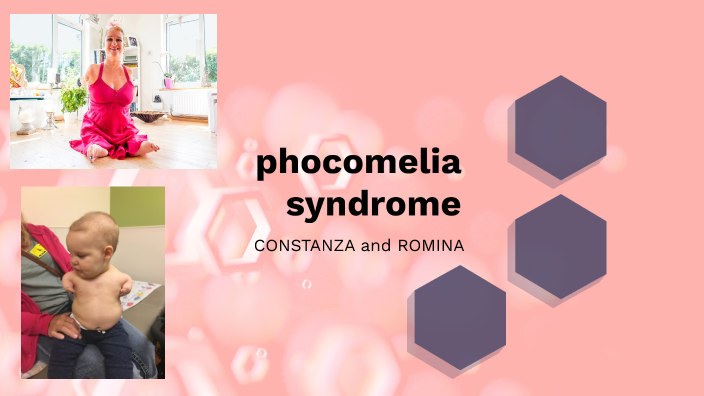 Phocomelia by cons c on Prezi