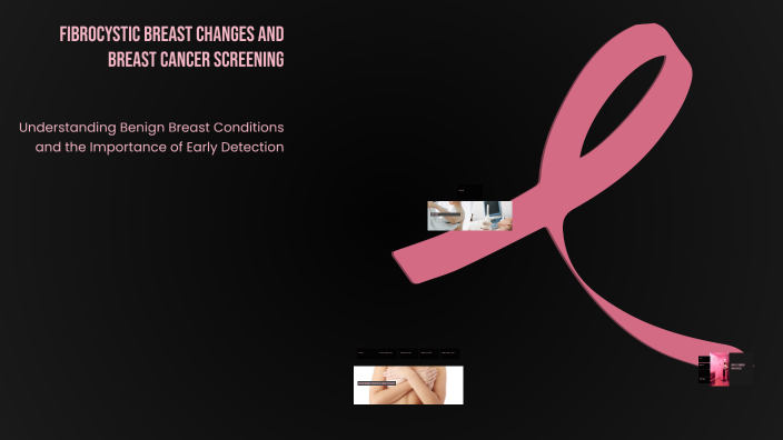 Fibrocystic Breast Changes and Breast Cancer Screening by Haider ...