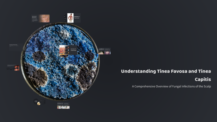 Understanding Tinea Favosa and Tinea Capitis by Сергей Иглов on Prezi