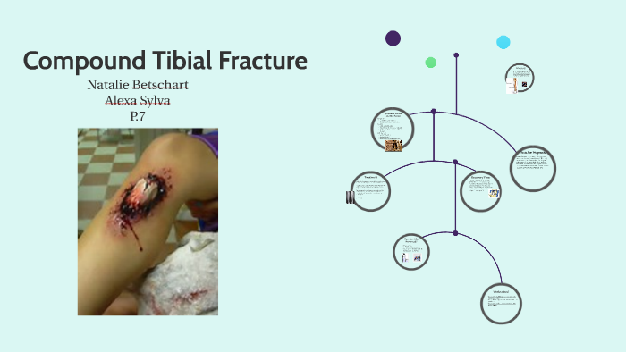 Compound Tibial Fracture by Alexa Sylva on Prezi