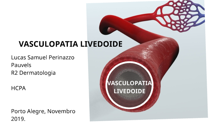 Vasculopatia Livedoide by Lucas Samuel Perinazzo Pauvels on Prezi