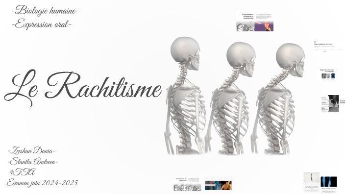 Le Rachitisme by Dania Zeeshan on Prezi
