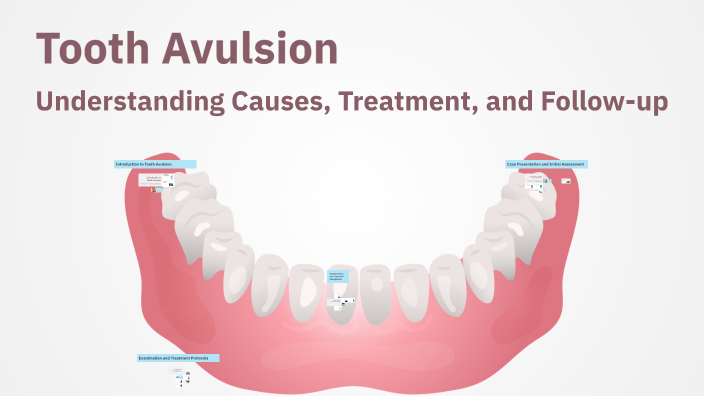 Tooth Avulsion by Abdulrahman Sawan on Prezi