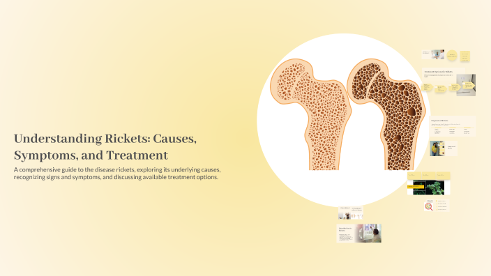 Understanding Rickets: Causes, Symptoms, and Treatment by akylai ...