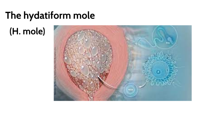 The hydatiform mole (H. mole) by avan khalil on Prezi