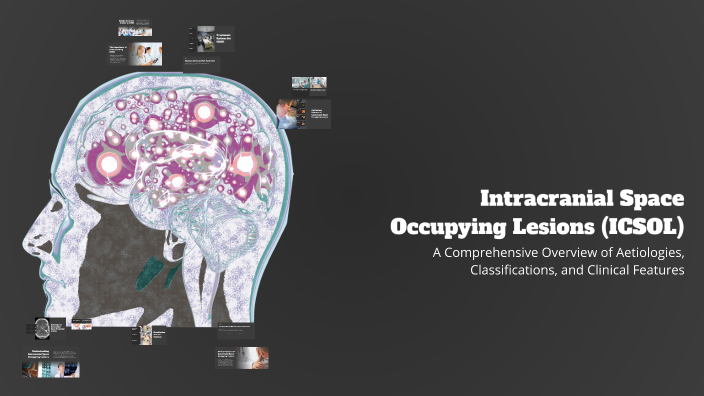 Intracranial Space Occupying Lesions (ICSOL) by Arif Mahmud on Prezi