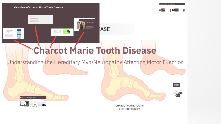 Charcot Marie Tooth Disease by Mitchell Mcdonald on Prezi
