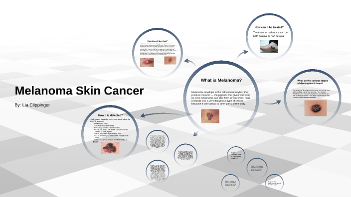 Melanoma Prezi Lia By Lia Lia On Prezi
