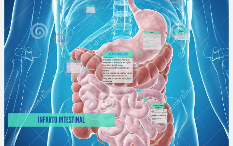 INFARTO INTESTINAL by Estefania Logroño on Prezi