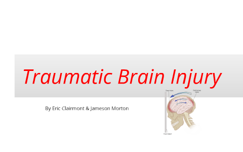 Traumatic Brain Injuries by Jameson Morton on Prezi