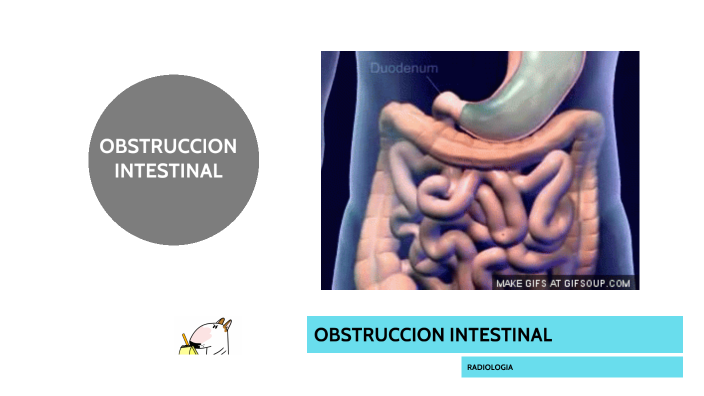 OBSTRUCCION INTESTINAL by LEONEL AVEROS on Prezi