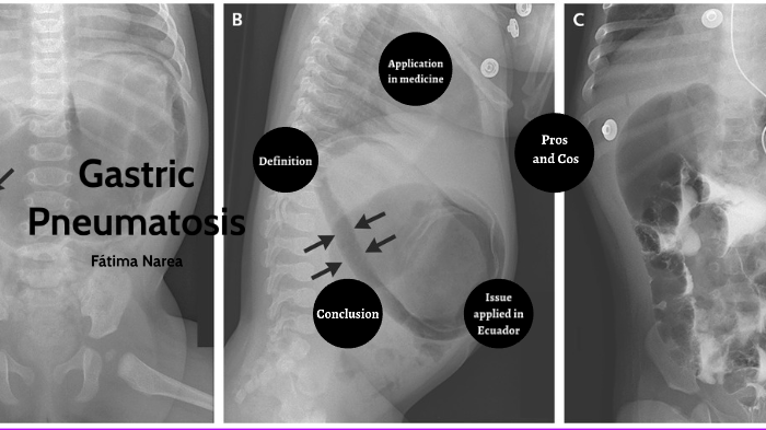 Gastric Pneumatosis by Fatima Styles on Prezi
