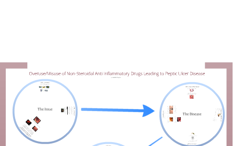 NSAID Overuse Leading to Peptic Ulcer Disease by Abdullah Chughtai on Prezi