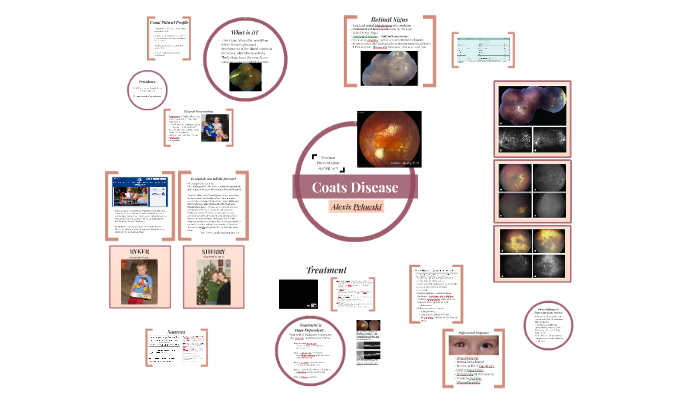 Coats Disease by Alexis Pelowski on Prezi