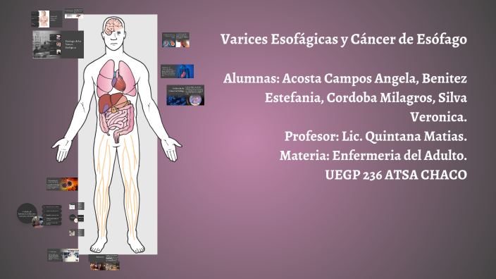Varices Esofágicas y Cáncer de Esófago by Ángela Acosta Campos on Prezi