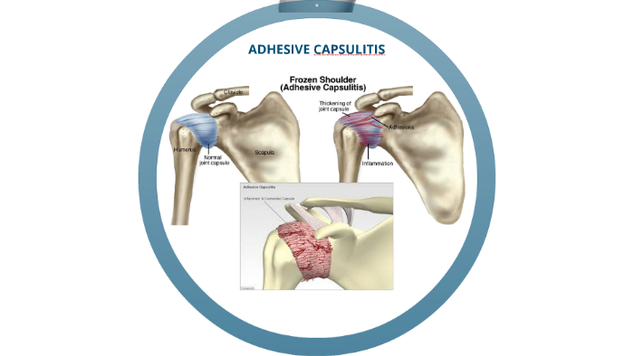Adhesive capsulitis by Harry Sutton on Prezi