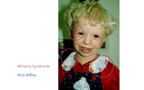 Williams Syndrome by Bizzy Willing on Prezi