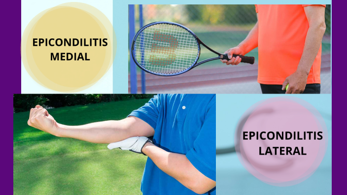 EPICONDILITIS LATERAL VS EPICONDILITIS MEDIAL by SHEYLA LINETH NEWMAN ...