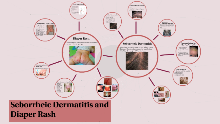 Seborrheic Dermatitis and Diaper Rash by Laura Macklin on Prezi