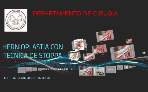 HERNIOPLASTIA CON TECNICA DE STOPPA by Juan Jose Ortega Mendez on Prezi