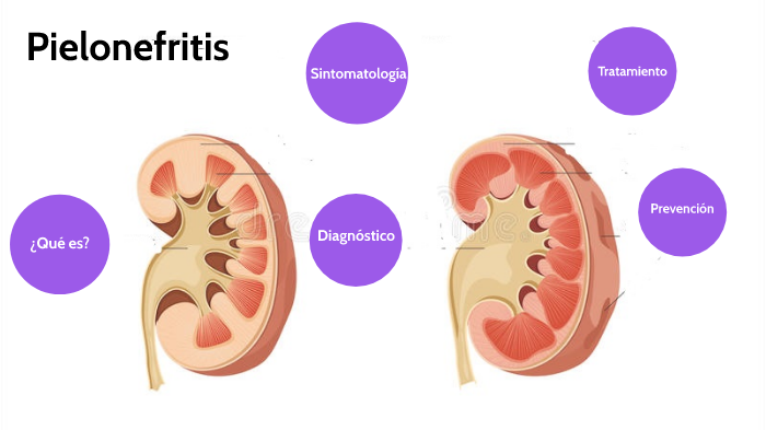 pielonefritis by MARGARITA GARCIA on Prezi