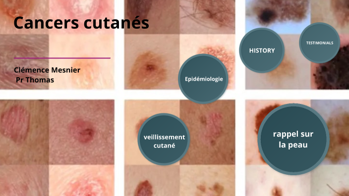 cancers cutanés by Clémence Mesnier on Prezi