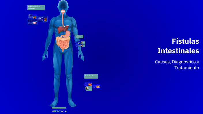 Fístulas Intestinales by maria jose guzman on Prezi