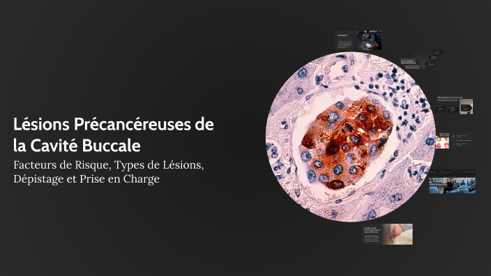 Lésions Précancéreuses de la Cavité Buccale by EDOUIEB JIHANE on Prezi