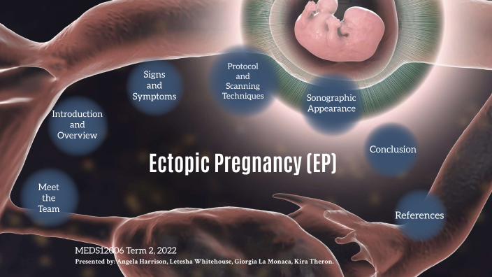 Group 8: Ecotopic Pregnancy by Kira Theron on Prezi
