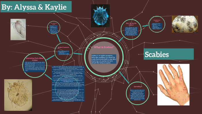 Scabies by Kaylie Hall on Prezi