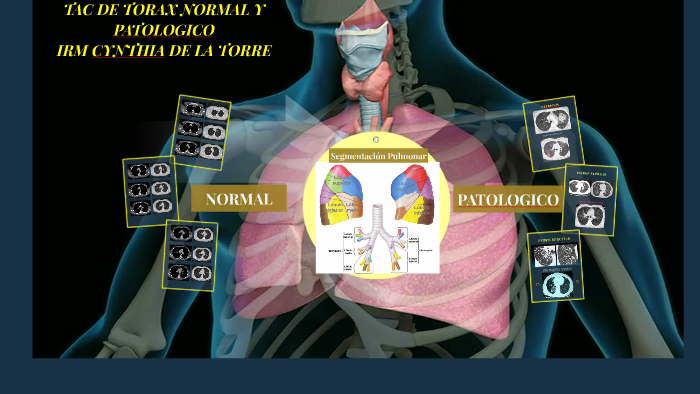 TAC DE TORAX NORMAL Y PATOLOGICO - DE LA TORRE by Cynthia De la Torre ...