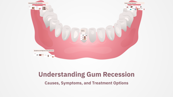 Understanding Gum Recession by Mahdieh Gh on Prezi