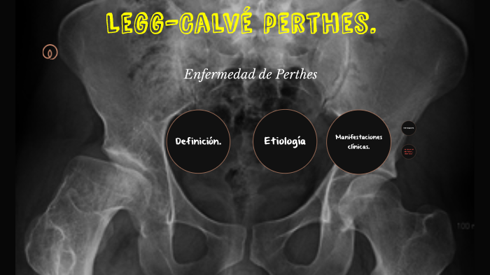 Legg-Calvé Perthes. by Clemen Mendez on Prezi